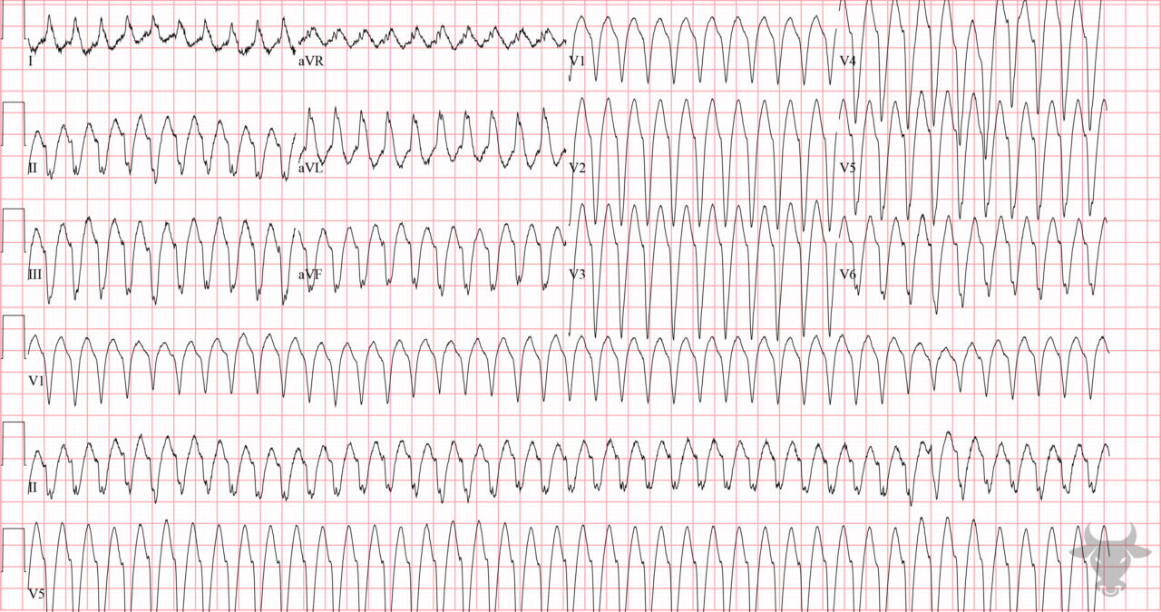 Ventricular Tachycardia | ECG Stampede