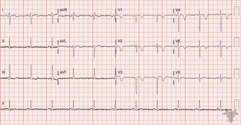 Wellens Syndrome | ECG Stampede