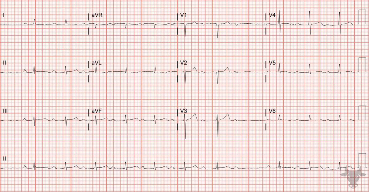 Second Degree Atrioventricular Block – Mobitz I | ECG Stampede