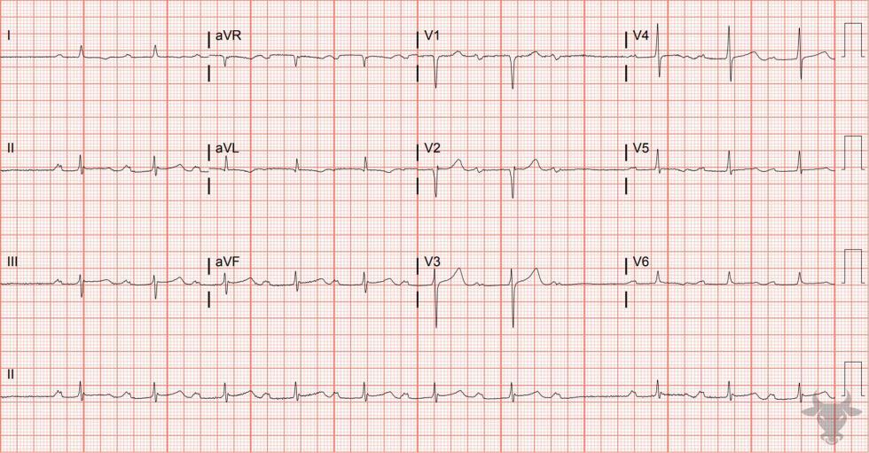 Second Degree Atrioventricular Block – Mobitz I | ECG Stampede