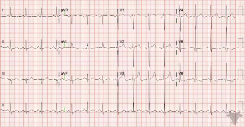 Left Ventricular Hypertrophy | ECG Stampede