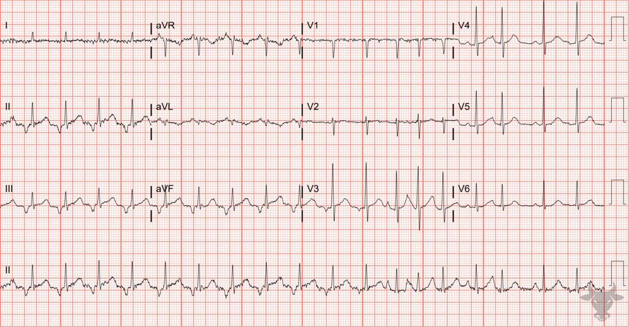 Multifocal Atrial Tachycardia | ECG Stampede