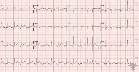 Multifocal Atrial Tachycardia | ECG Stampede