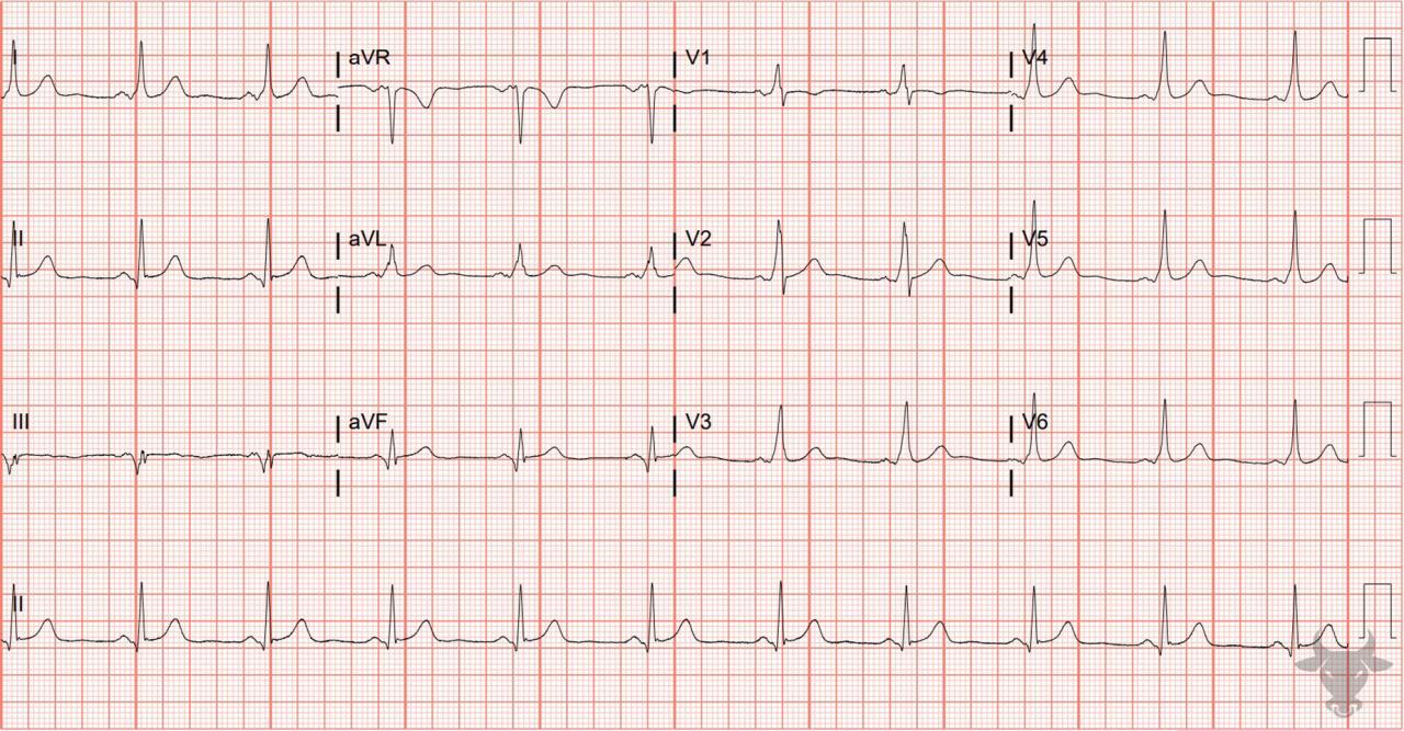 Ventricular Pre-excitation | ECG Stampede