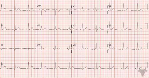 Ventricular Pre-excitation | ECG Stampede