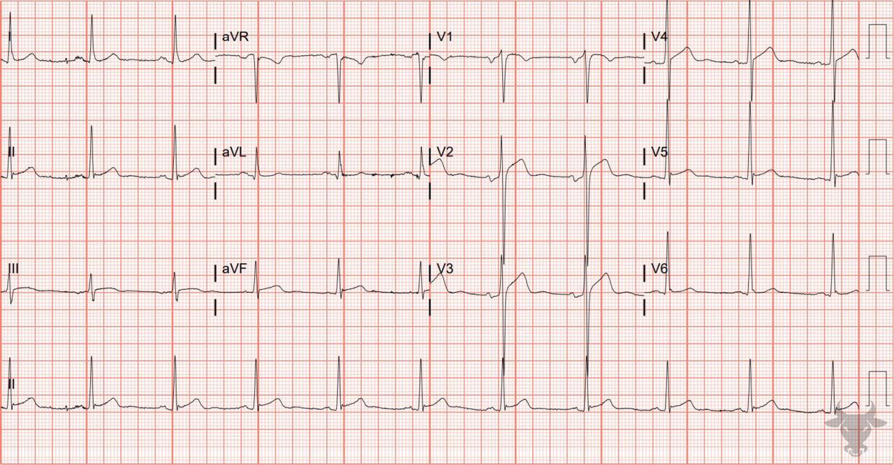 Left Ventricular Hypertrophy | ECG Stampede