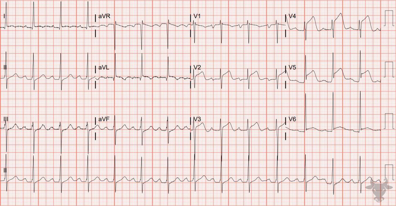 Left Ventricular Hypertrophy | ECG Stampede