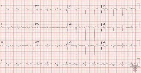 Poor R-wave Progression | ECG Stampede