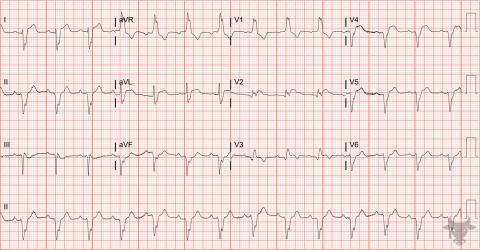 Bifascicular Block | ECG Stampede
