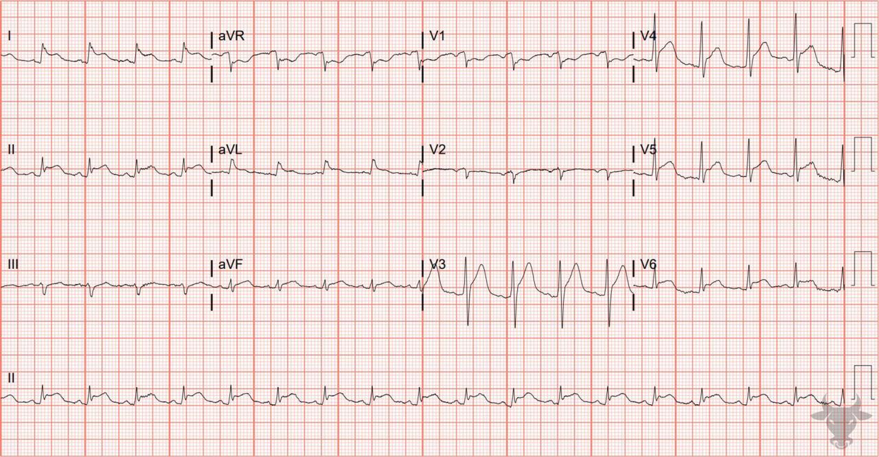 Acute Pericarditis | ECG Stampede