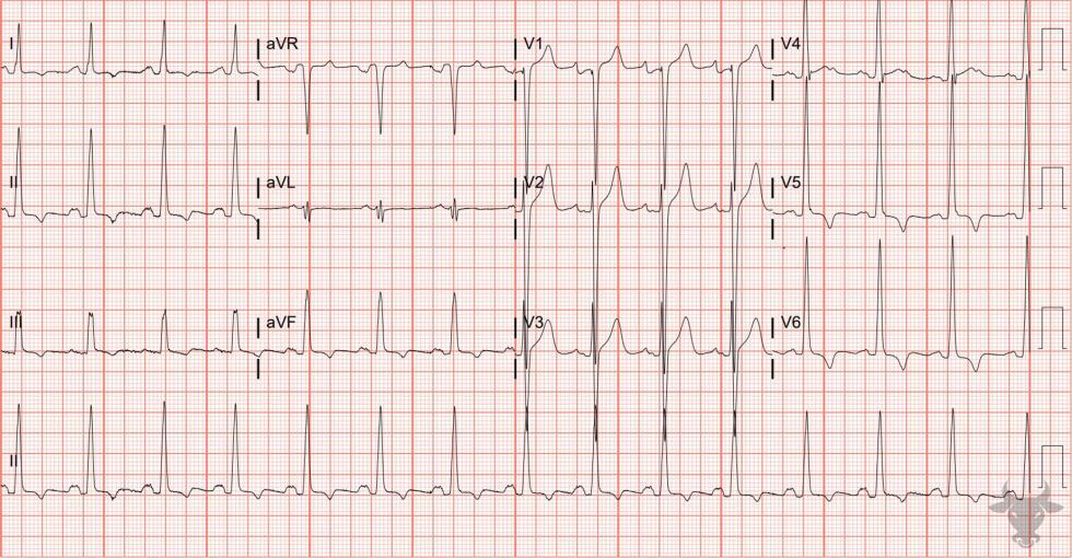 Left Ventricular Hypertrophy | ECG Stampede