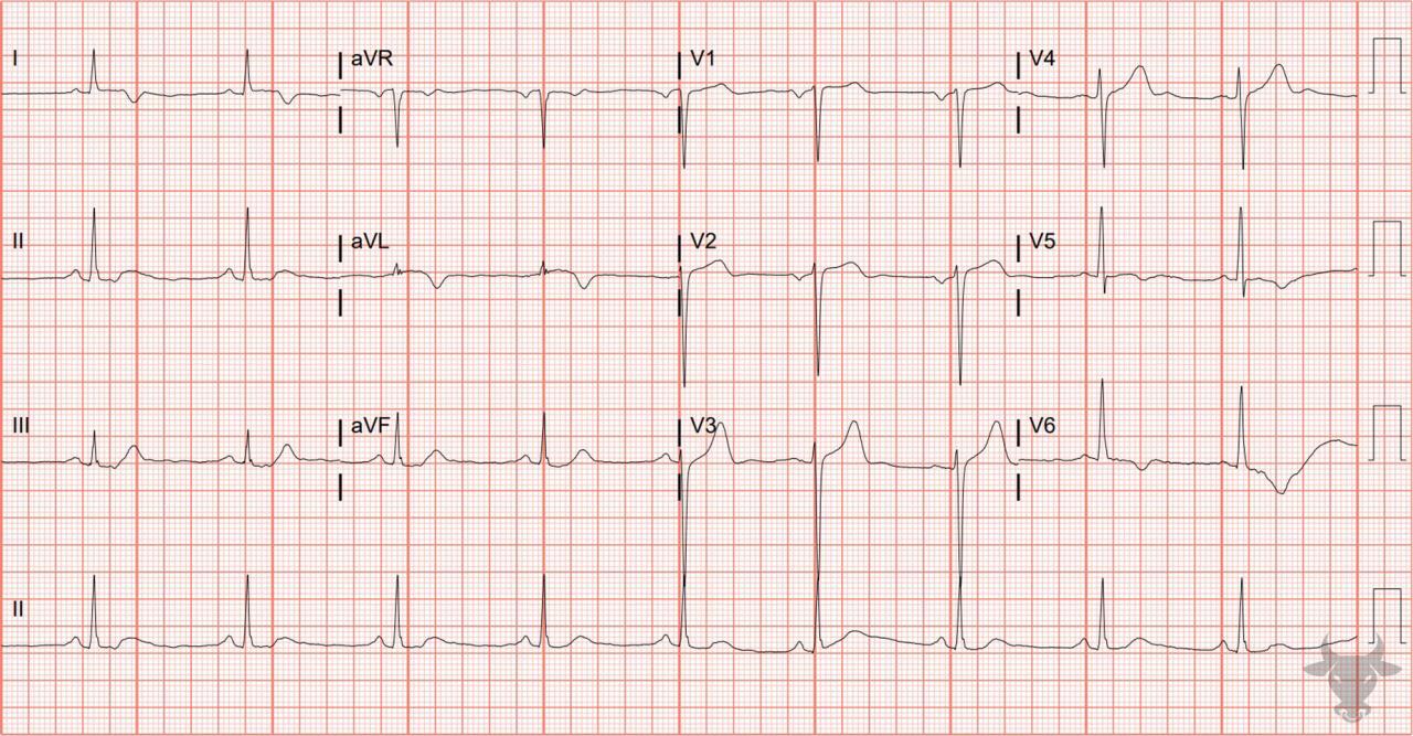 Left Ventricular Hypertrophy | ECG Stampede