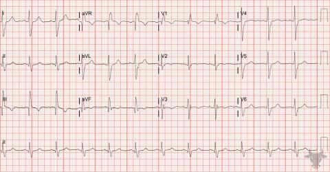 Bifascicular Block | ECG Stampede