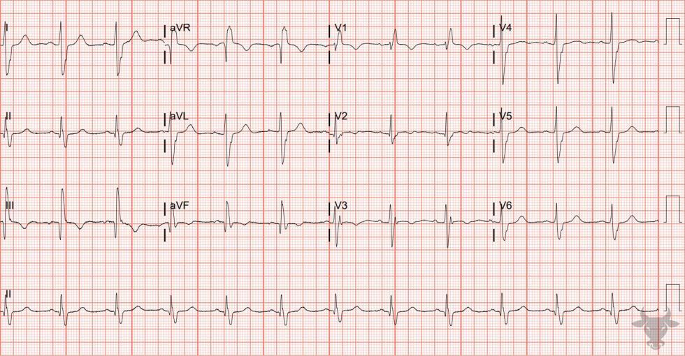 Bifascicular Block | ECG Stampede