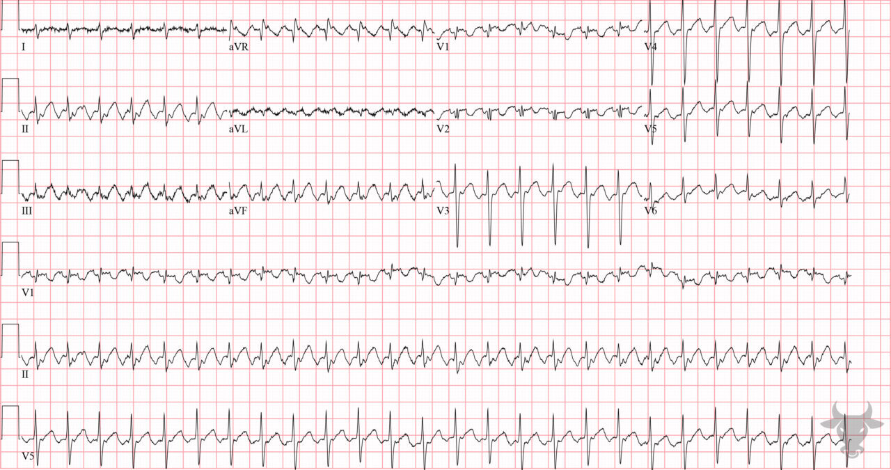 Atrial Flutter Ecg Stampede