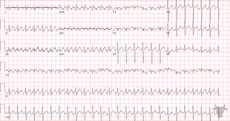 Atrial Flutter | ECG Stampede