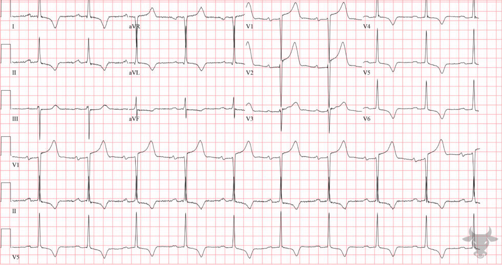 Left Ventricular Hypertrophy | ECG Stampede