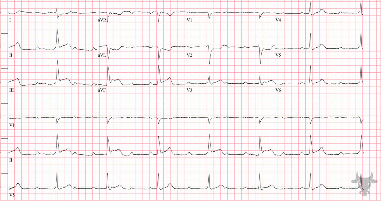 Third Degree Atrioventricular Block | ECG Stampede