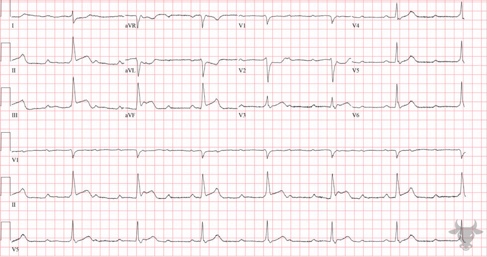 Third Degree Atrioventricular Block | ECG Stampede