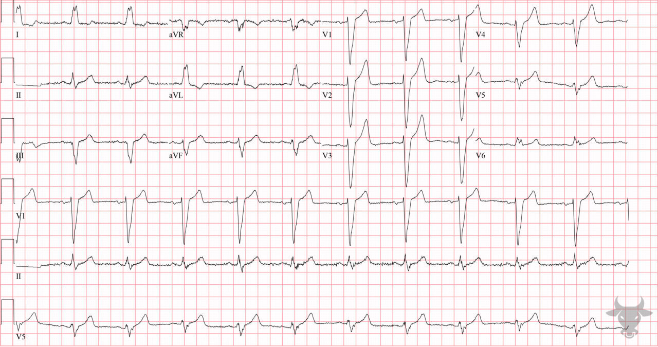 Left Bundle Branch Block | ECG Stampede