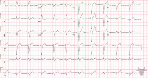 Left Bundle Branch Block | ECG Stampede