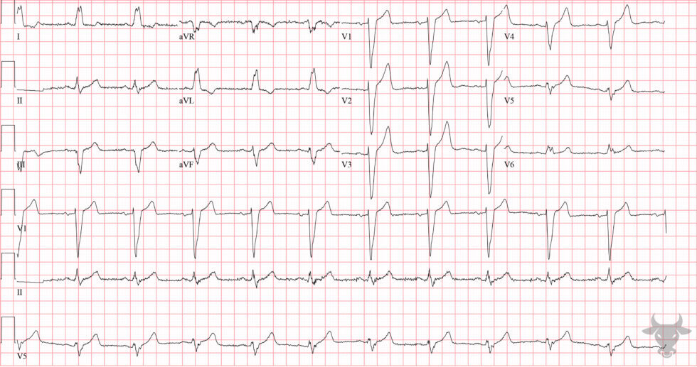 Left Bundle Branch Block | ECG Stampede