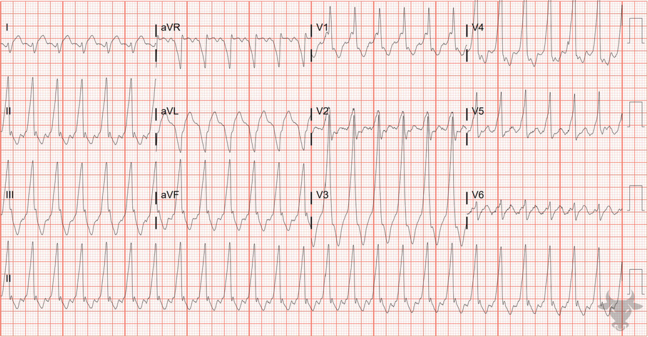 Ventricular Pre-excitation | ECG Stampede
