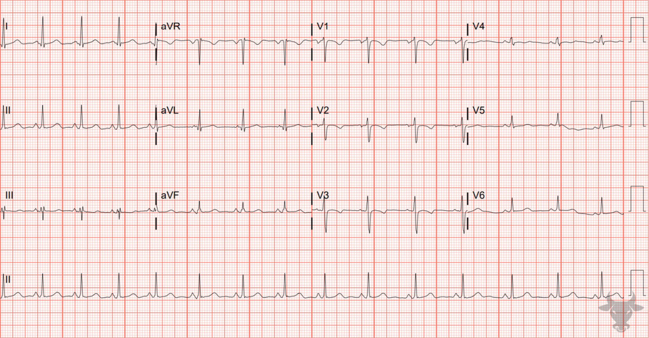 Persistent Juvenile T Wave Pattern | ECG Stampede