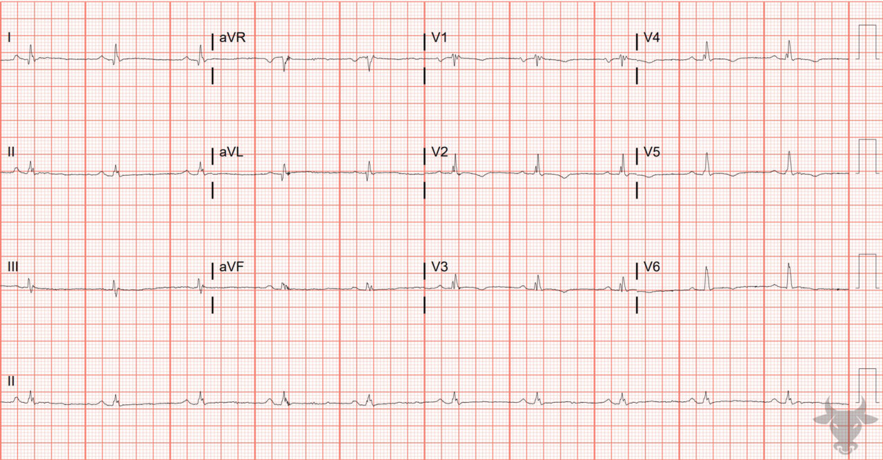 Arrhythmogenic Right Ventricular Cardiomyopathy | ECG Stampede