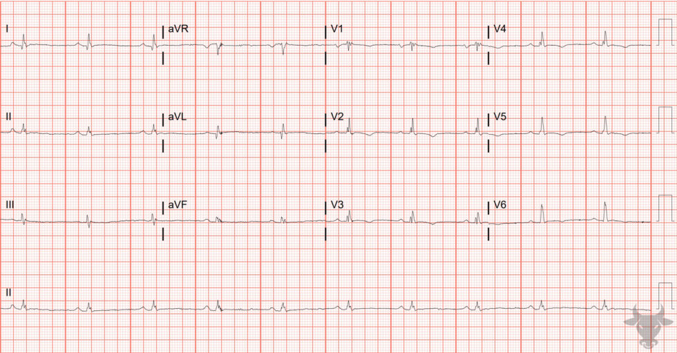 Arrhythmogenic Right Ventricular Cardiomyopathy | ECG Stampede