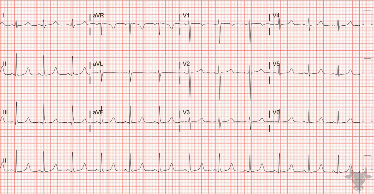 Prolonged QT | ECG Stampede