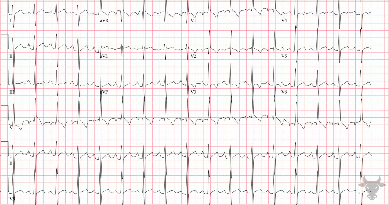 Right Atrial Enlargement | ECG Stampede