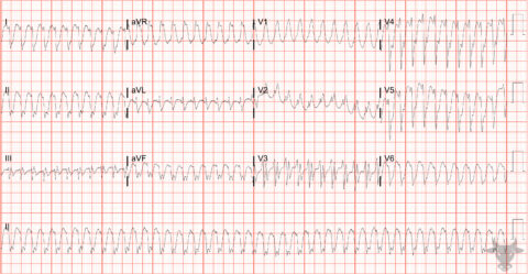 Supraventricular Tachycardia with Aberrancy | ECG Stampede