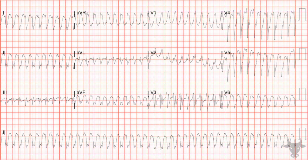 Supraventricular Tachycardia with Aberrancy | ECG Stampede