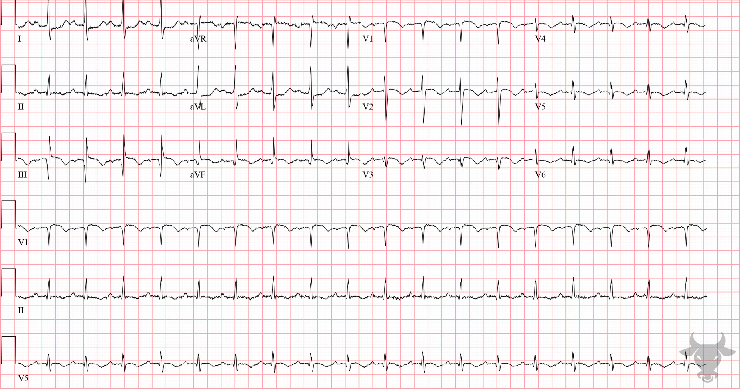 Pulmonary Embolism ECG Stampede Pulmonary Embolism ECG Stampede