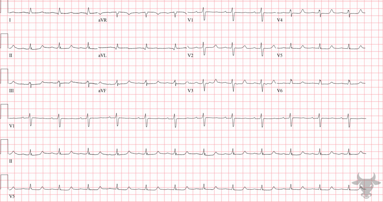 Prolonged QT | ECG Stampede