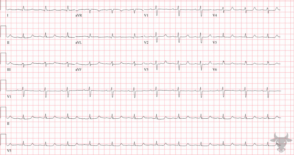 Prolonged QT | ECG Stampede
