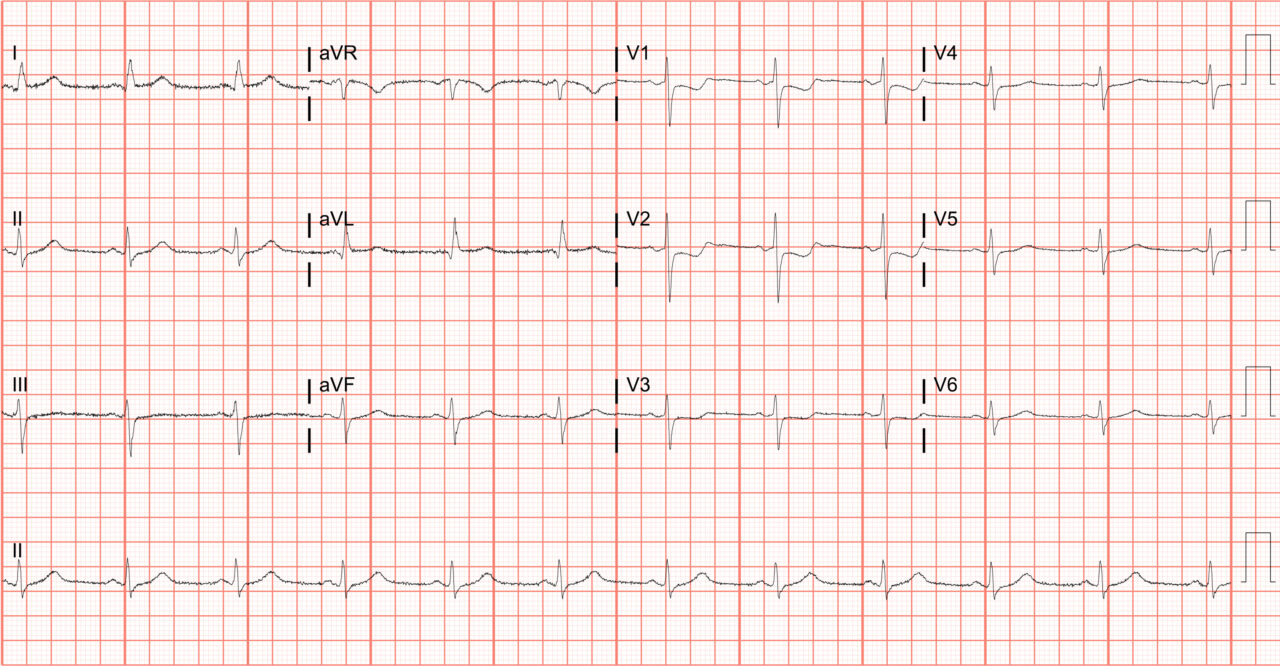 Posterior Myocardial Infarction | ECG Stampede