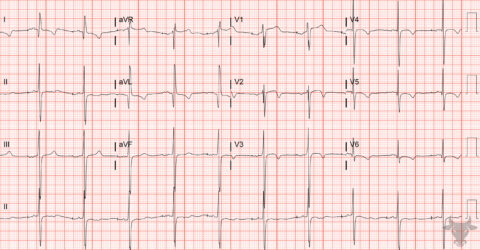Hypertrophic Cardiomyopathy | ECG Stampede