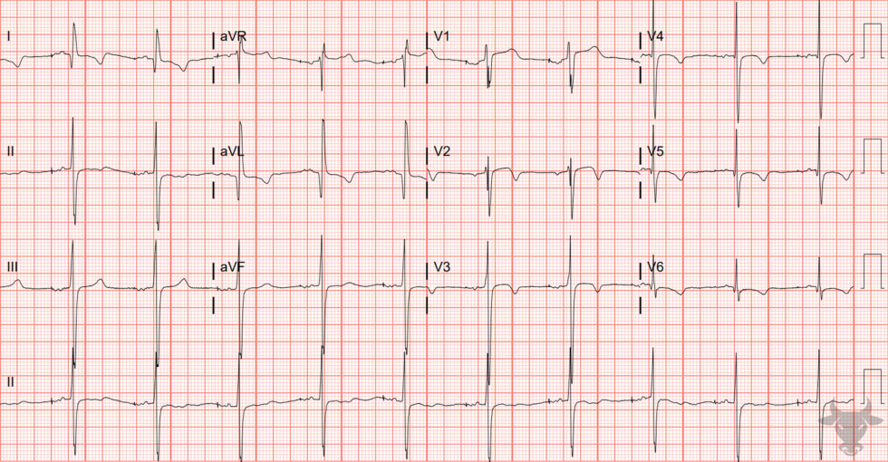 Hypertrophic Cardiomyopathy | ECG Stampede