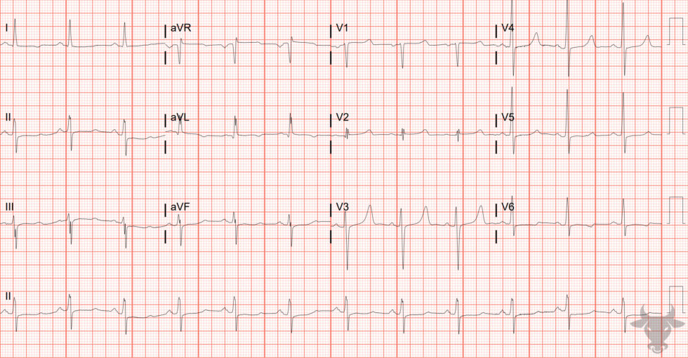 Hypocalcemia | ECG Stampede