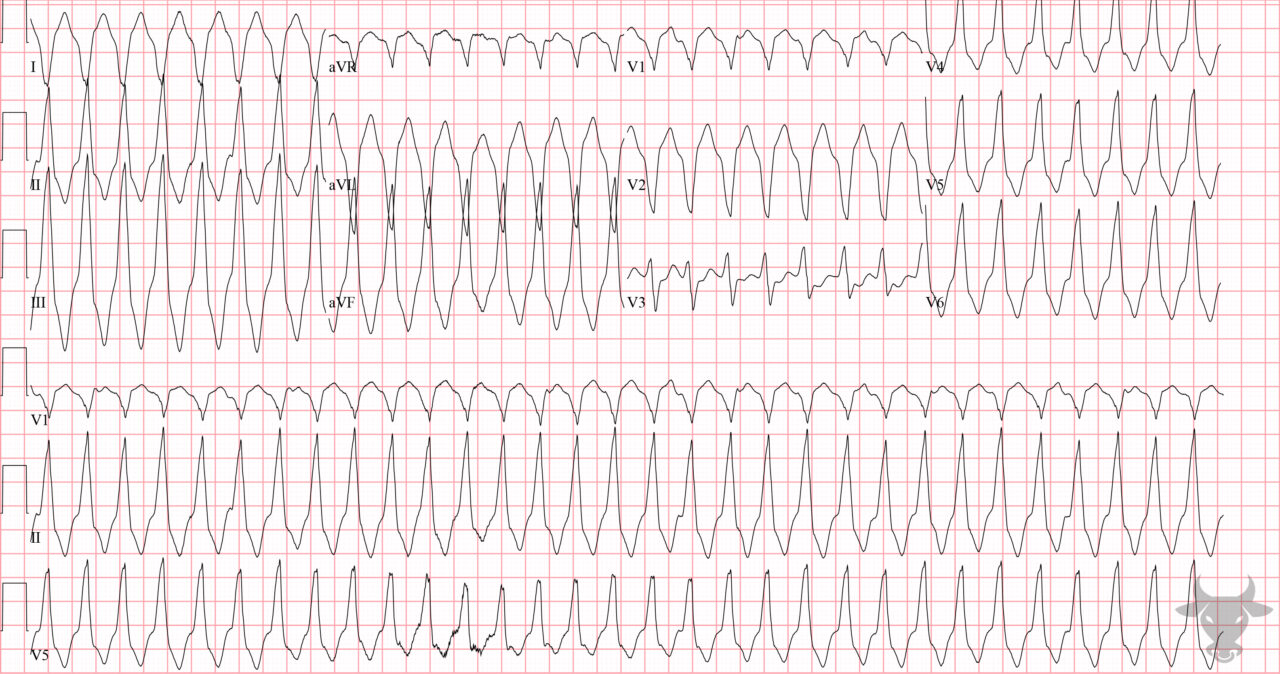 Arrhythmogenic Right Ventricular Cardiomyopathy | ECG Stampede