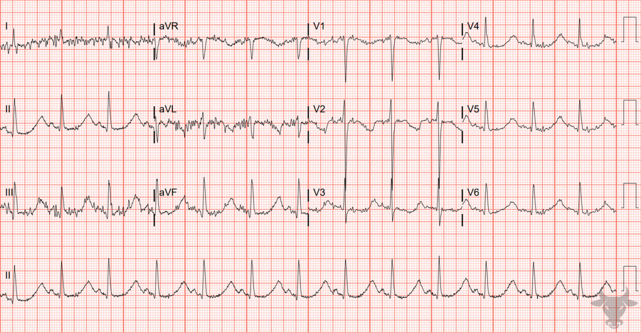 Prolonged QT | ECG Stampede